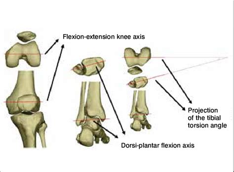 The Tibial Torsion Angle Formed By The Projection Of The Axes Of The