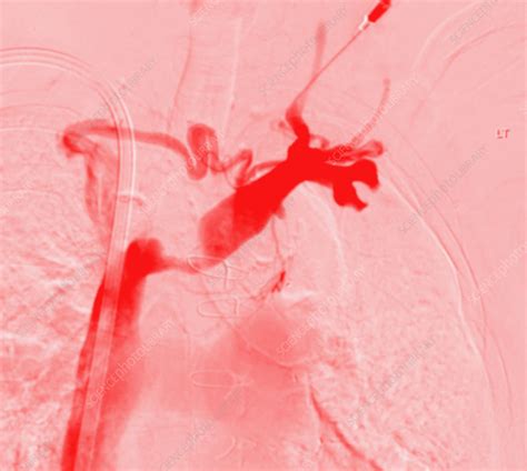 Balloon Angioplasty For Blocked Artery Angiogram Stock Image F043