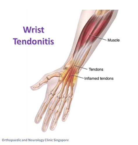 Wrist Tendonitis [solution] Meticulous Wrist Clinic