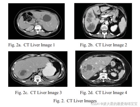 8 论文学习liver tumor segmentation and classification a systematic review