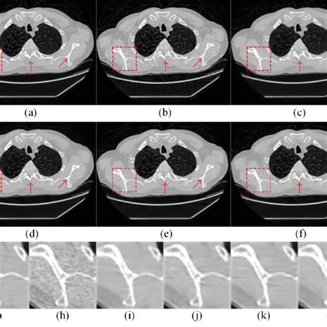 Pdf Low Dose Ct Via Convolutional Neural Network