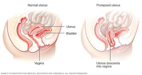 Uterine Prolapse Symptoms And Causes Mayo Clinic