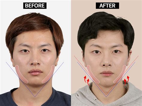 V Line Jaw Surgery Recovery At Daryl Hudson Blog