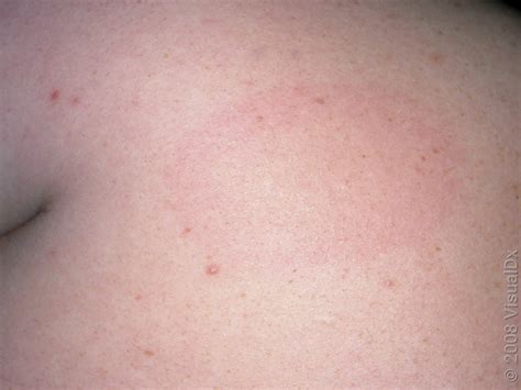 What Does A Tick Bite Look Like A Week Later Infoupdate Org