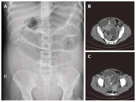 Enteric Duplication Cyst As A Leading Point For Ileoileal Intussusception In An Adult A Rare