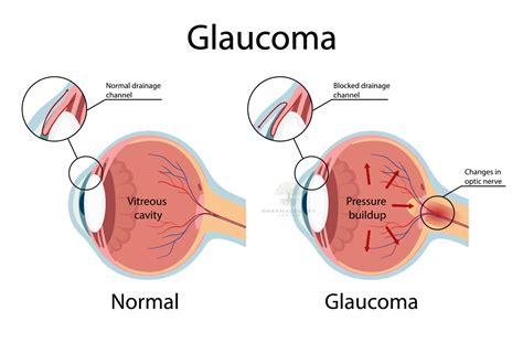Glaucoma Pathophysiology Treatment Pharmacology Mentor