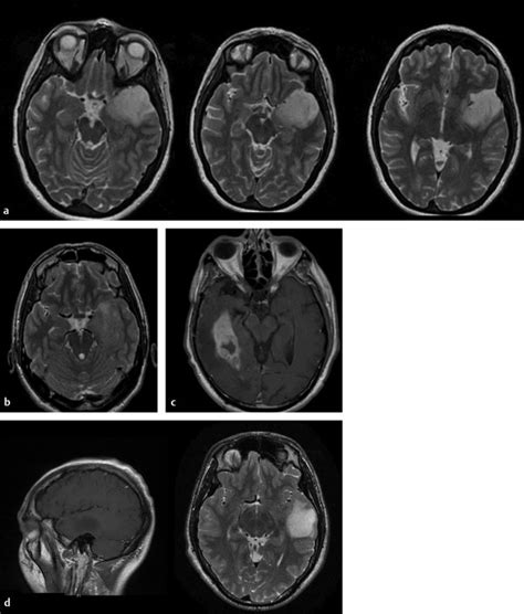 11 Temporal Lobe Gliomas Neupsy Key