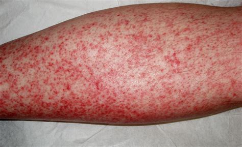 Dress Shirt Neck Rash At Yvette Branch Blog