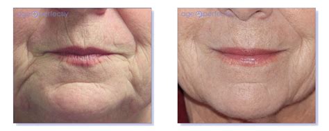 Filler Injections7 Age Perfectly