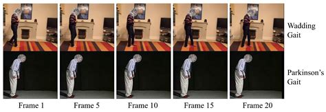 Fp Gcn Frequency Pyramid Graph Convolutional Network For Enhancing Pathological Gait Classification