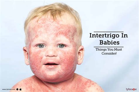 Intertrigo In Babies Things You Must Consider By Dr Pradeep