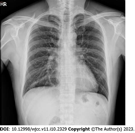 Central Peribronchial Thickening