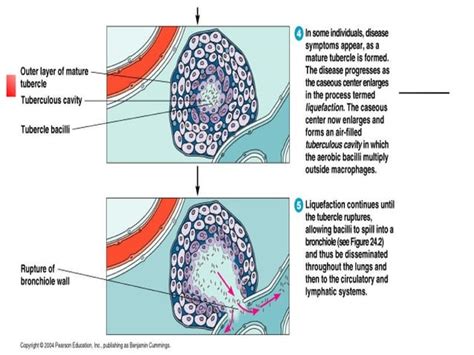 Tuberclosis Ppt