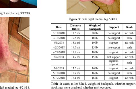 Table 1 From Exercise Induced Vasculitis Semantic Scholar