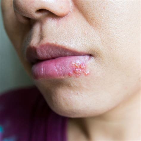 Doenca De Herpes Na Boca Vírus Herpes Simples Tipo 1 E 2 Dra