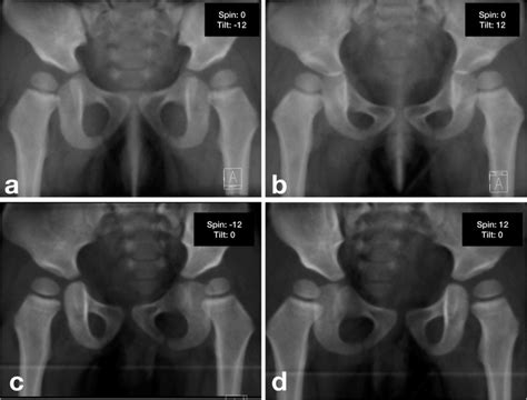 Drrs Generated At Different Pelvic Positions A Posteriorly Tilt To