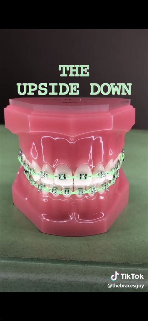 Got This From Thebracesguy On Tiktok Dental Braces Colors Cute Braces