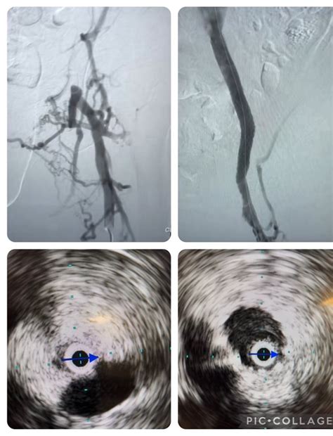 Right Pelvic Wall Mass Chronic Occlusive Iliac Vein Dvt With Severe
