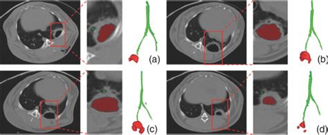 Ad Examples For Airway And Cavity Extraction Download Scientific Diagram