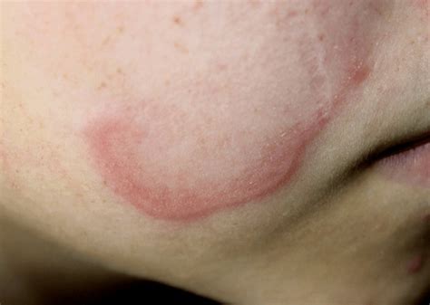 2 En La Categoría Centrifugal Lesion De Fotos E Imágenes De Stock