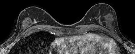Accuracy And Interpretation Time Of Computer Aided Detection Among Novice And Experienced Breast