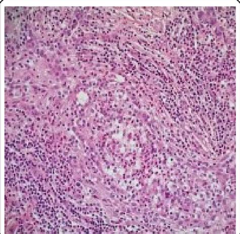 Mastitis Delineating Acute Inflammatory Cells Impacting And Surrounding