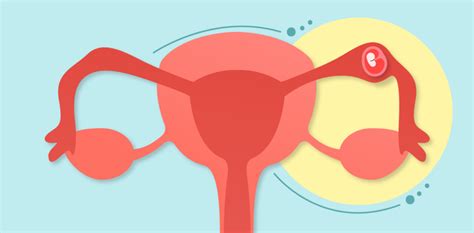 ¿qué Es Un Embarazo Ectópico Y Cuáles Son Las Causas Procrea