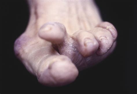 Lesser Toe Abnormalities Clinical Tree