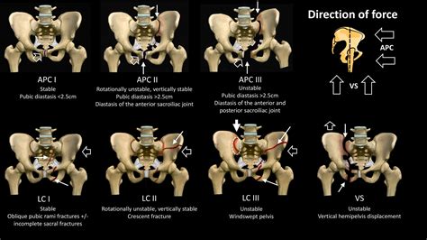 High Energy Pelvic Ring Injuries A Comprehensive Imaging