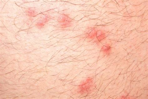 How To Identify These 9 Common Bug Bites Readers Digest How To Identify These 9 Common Bug Bites Readers Digest