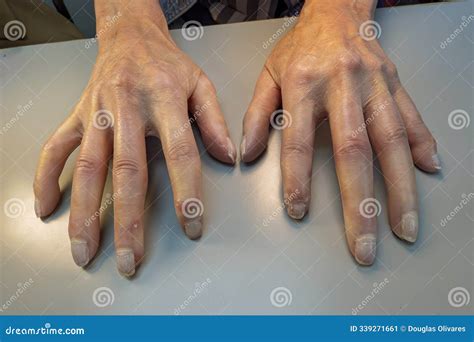 Female Patient Hands With Scleroderma Stock Image Image Of Illness Healthcare 339271661