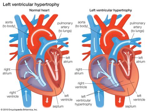 Ventricular Heart Valve At Doreen Woods Blog