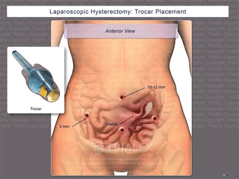 Laparoscopic Hysterectomy Trocar Placement Trialquest Inc