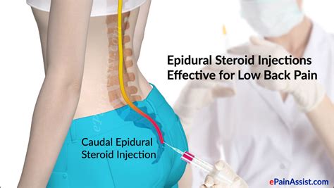 Back Pain From Epidural Two Years Later Mapasgmaes