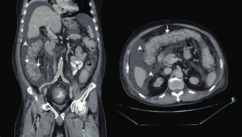 Abdominal Ct Scan With Intravenous Oral And Rectal Contrast Revealed