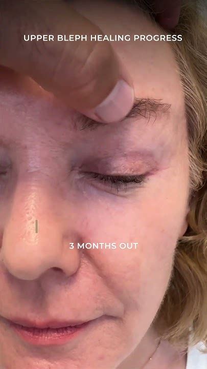 Upper Bleph Healing Progress Youtube