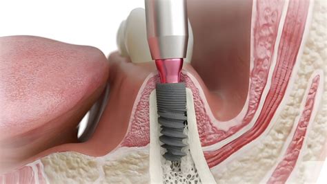 Dental Implant Healing Stages What To Expect