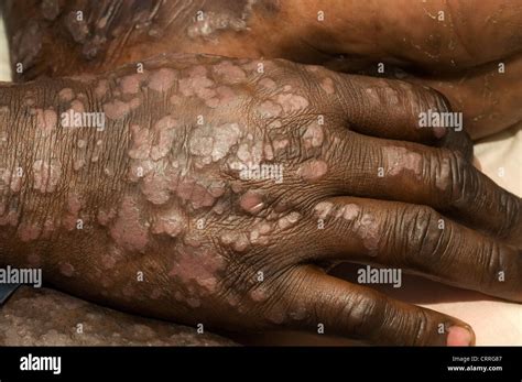 A Patient With Severe Extensive Psoriasis All Over Their Body Stock