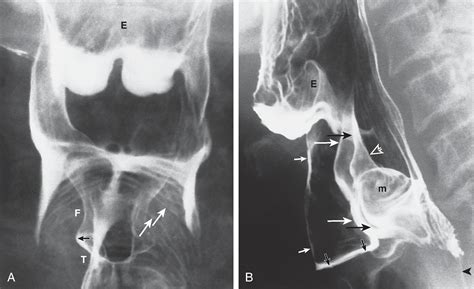 Pharynx Normal Anatomy And Function And Examination Techniques