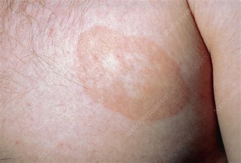 Tinea Corporis Ringworm Of Body Area Stock Image M2700057