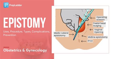 Epistomy Uses Procedure Types Benefits And Prevention
