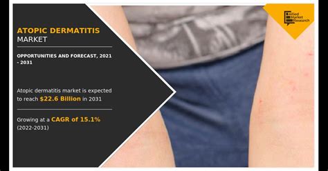 Atopic Dermatitis Market Facts Future Scenarios Growth And Analytical Insights 2031 Cagr Of