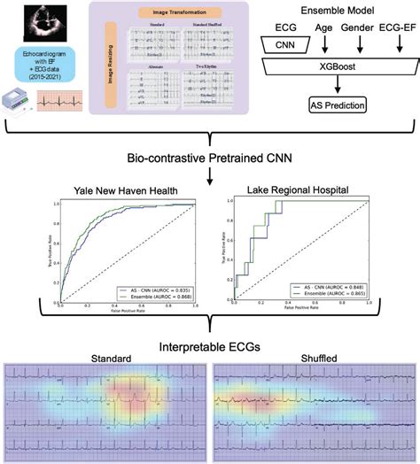 Smart As A Novel Artificial Intelligence Tool To Detect Severe Aortic Stenosis From