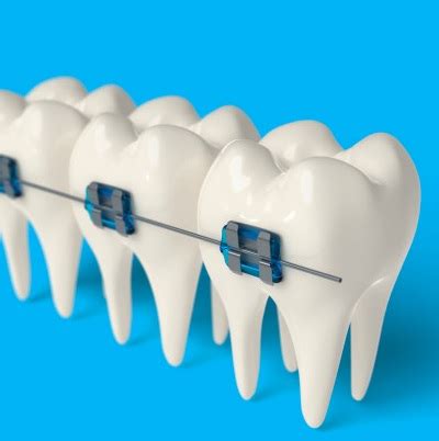 Braces Breaking And Wires Snapping What You Need To Do About These Orthodontic Emergencies
