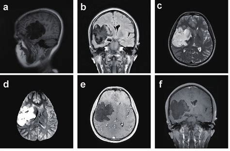 Preoperative Mri Scan Of The Brain Demonstrated A Large Right Sylvian