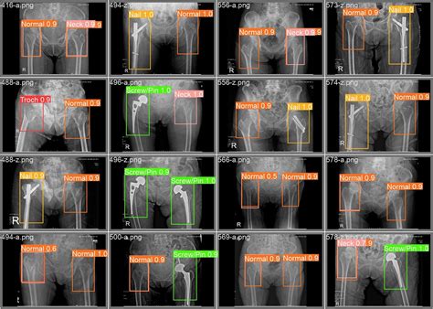 Development Of A Machine Learning Model For Bone Fracture Assessment