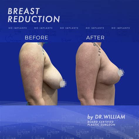 Breast Reduction Dr William Miami
