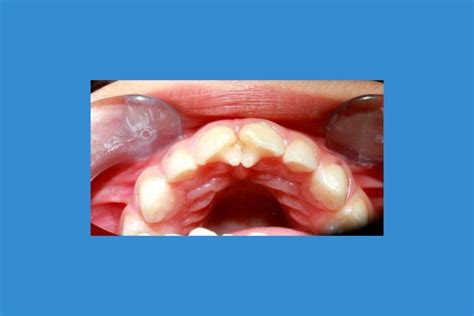 What Is A Talon Cusp Tooth