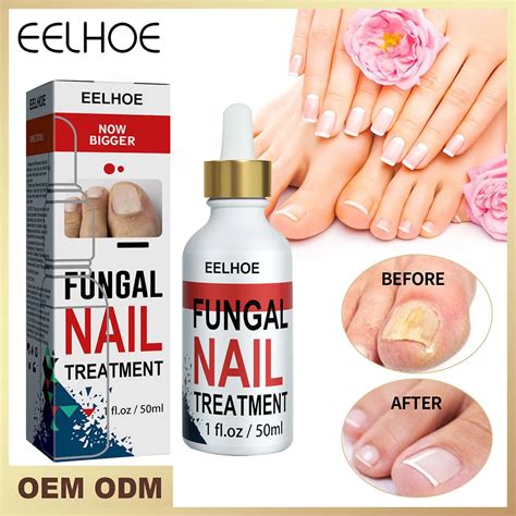 Nail Fungal Treatment Serum Anti Infection Onychomycosis Paronychia Toe