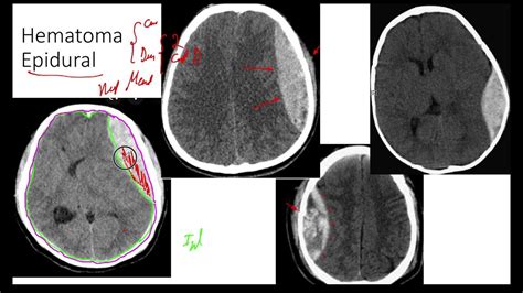 Hematoma Epidural Tomografía Computarizada Hemorragia Intracraneal